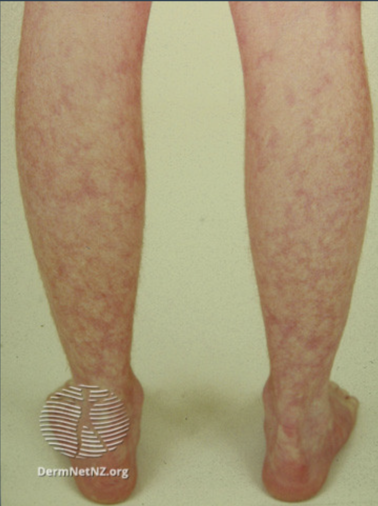 抗磷脂質症候群—診斷與治療簡介 – 過敏免疫風濕科—許伯爵醫師專業分享網誌